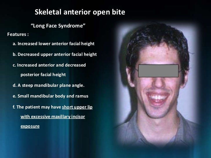 Management of Open Bite - Dr. Nabil Al-Zubair
