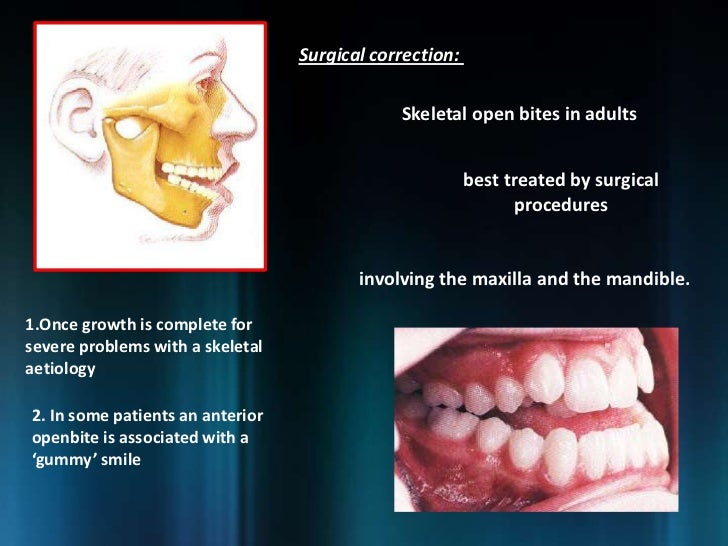Management of Open Bite - Dr. Nabil Al-Zubair