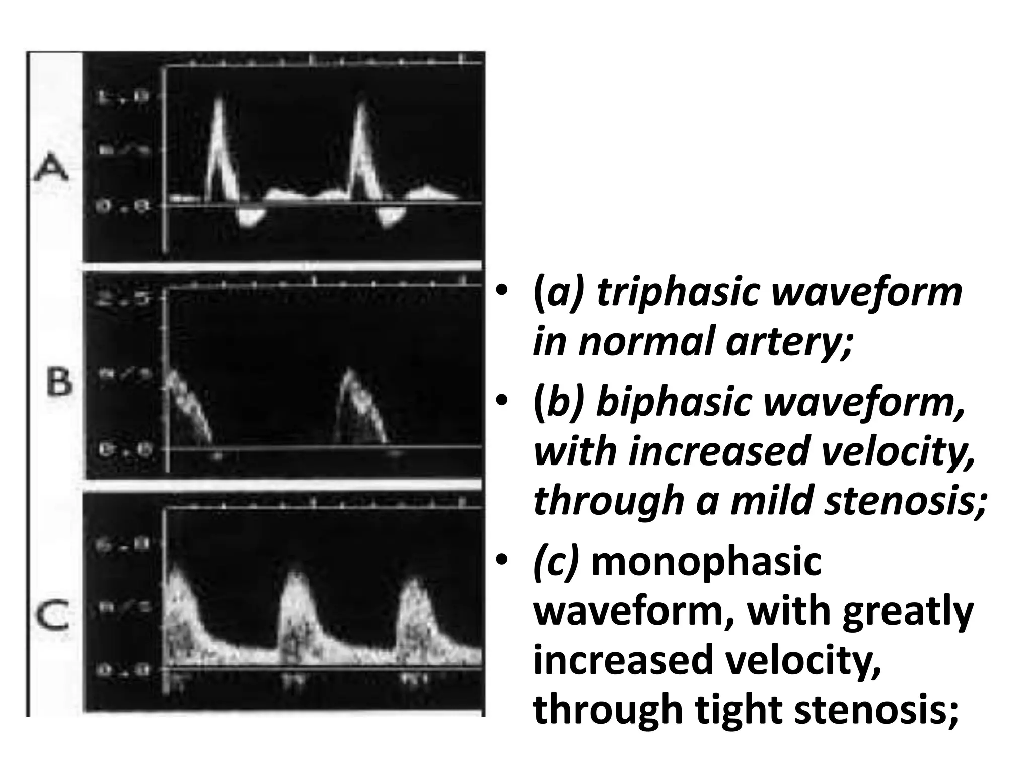 COMPARTMENT SYNDROME | PPTX