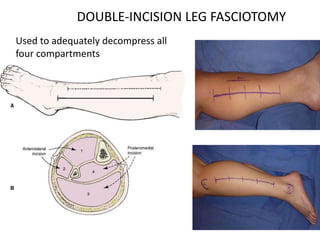 COMPARTMENT SYNDROME | PPTX