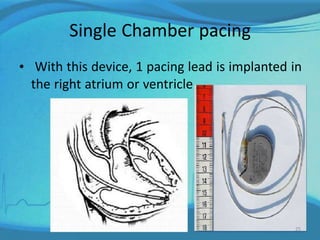 The pacemaker | PPTX