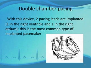 The pacemaker | PPTX