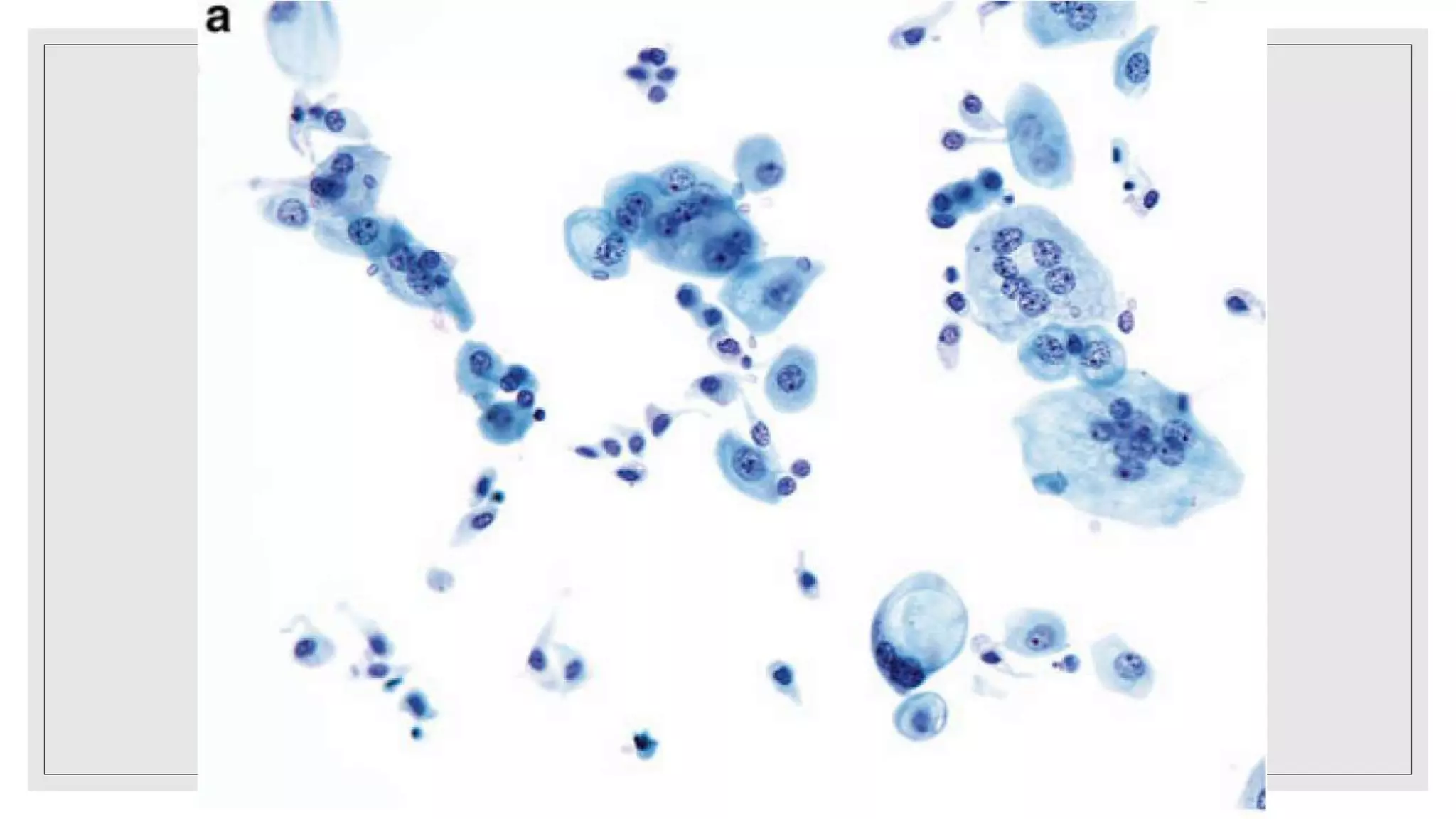 The Paris System for Reporting Urinary Cytology | PPTX