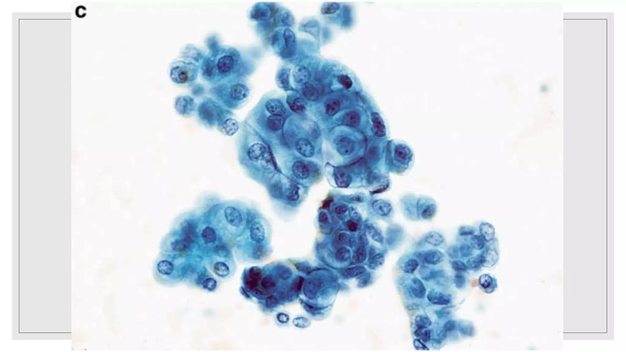 The Paris System for Reporting Urinary Cytology | PPTX