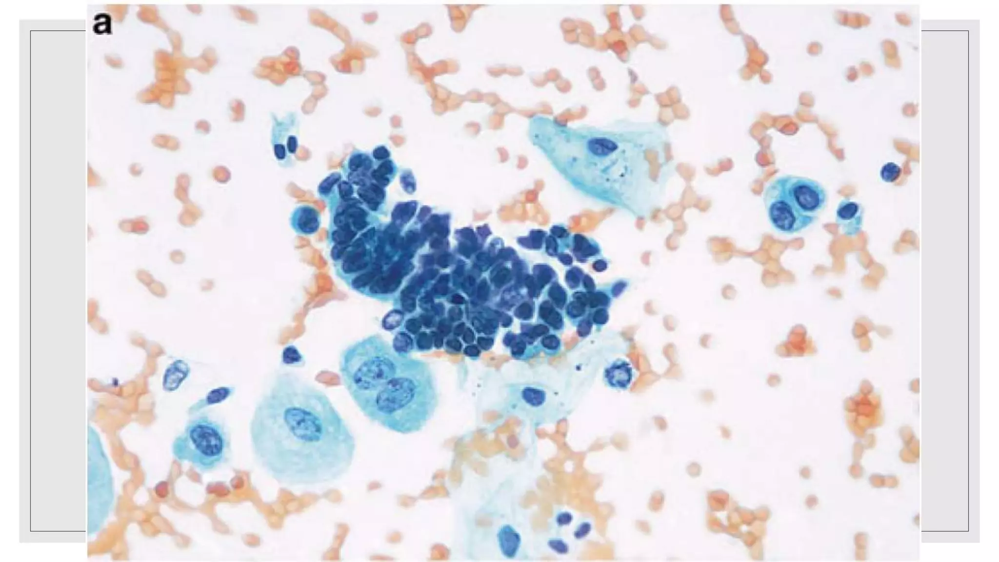 The Paris System for Reporting Urinary Cytology | PPTX