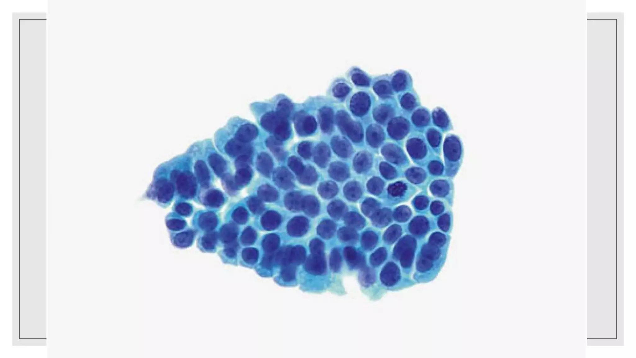 The Paris System for Reporting Urinary Cytology | PPTX