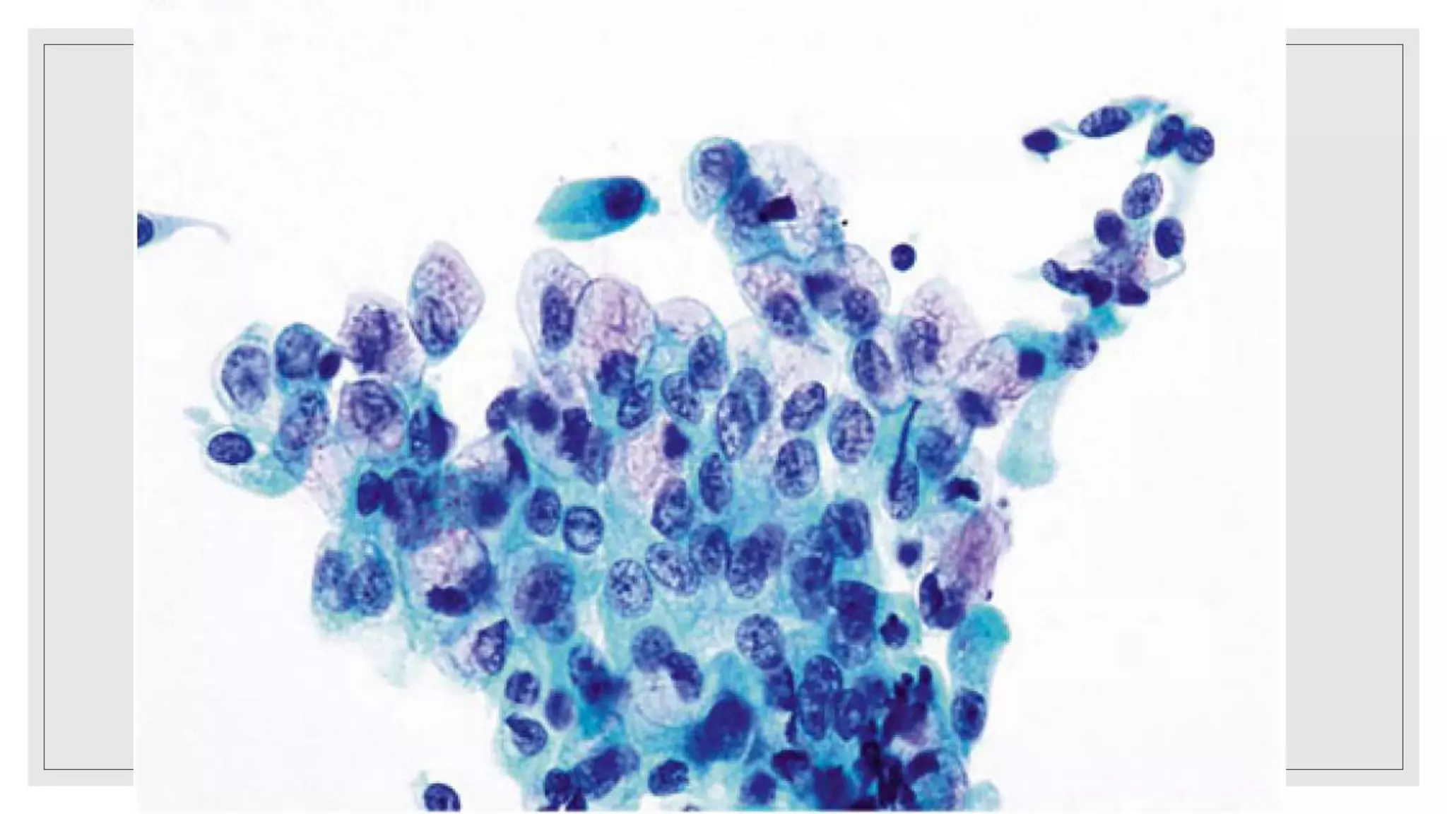 The Paris System for Reporting Urinary Cytology | PPTX