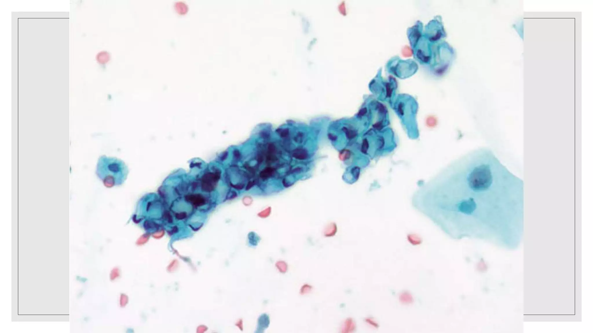 The Paris System for Reporting Urinary Cytology | PPTX