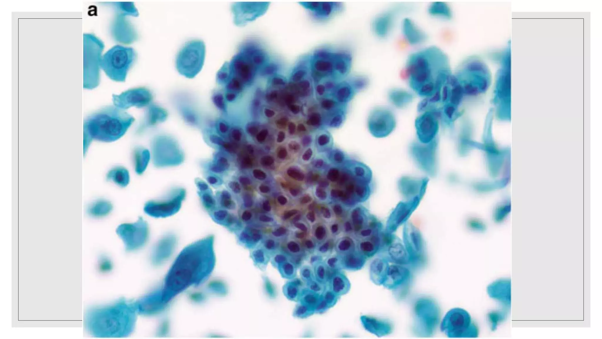 The Paris System for Reporting Urinary Cytology | PPTX