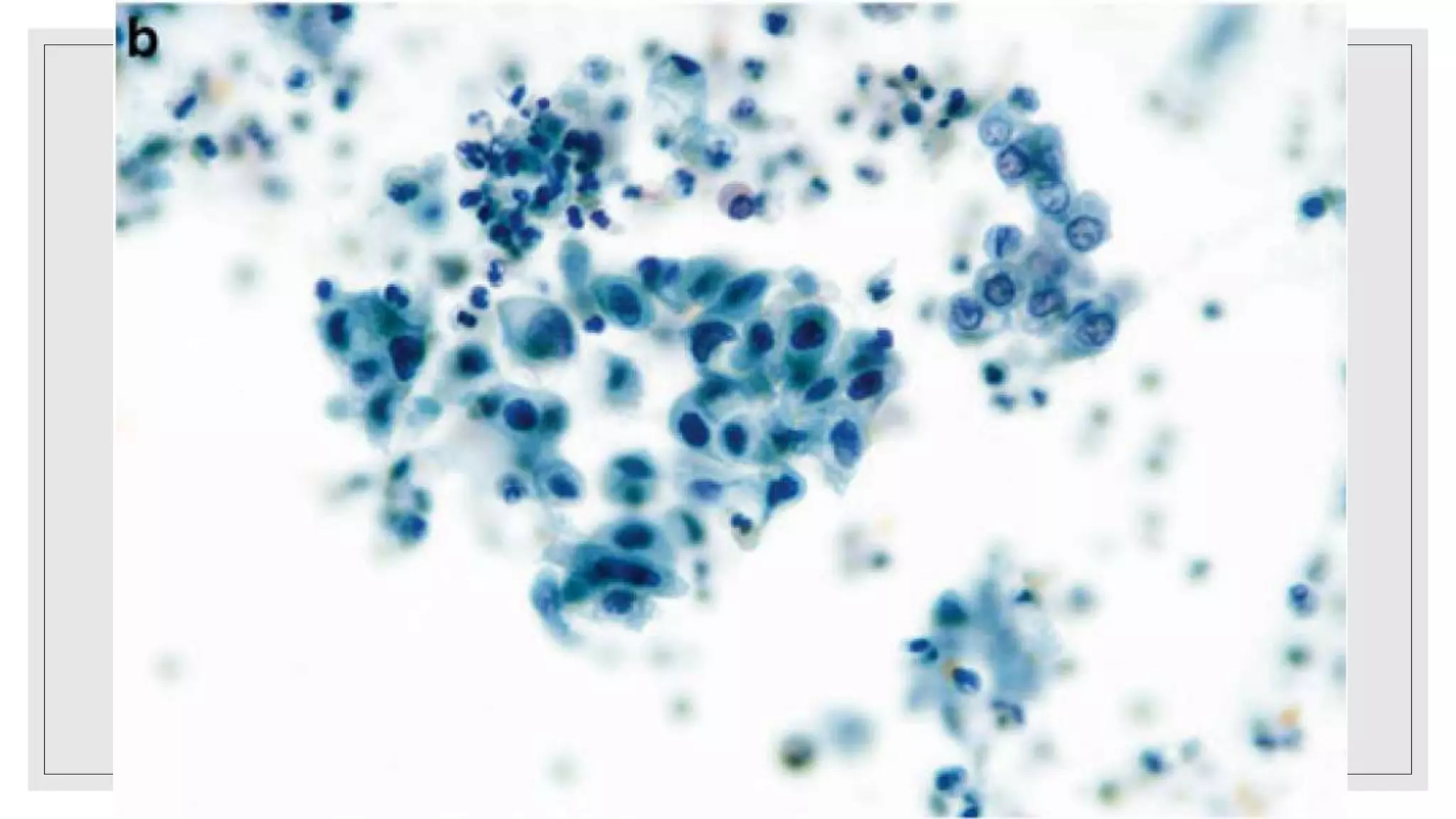 The Paris System for Reporting Urinary Cytology | PPTX