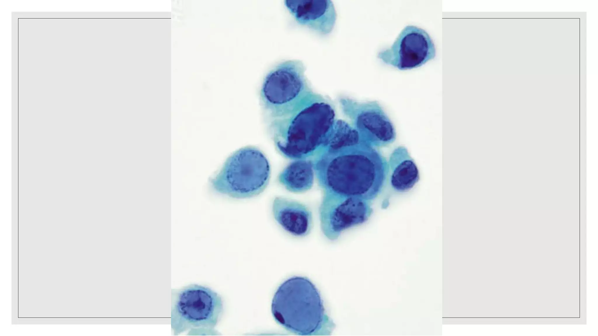 The Paris System for Reporting Urinary Cytology | PPTX