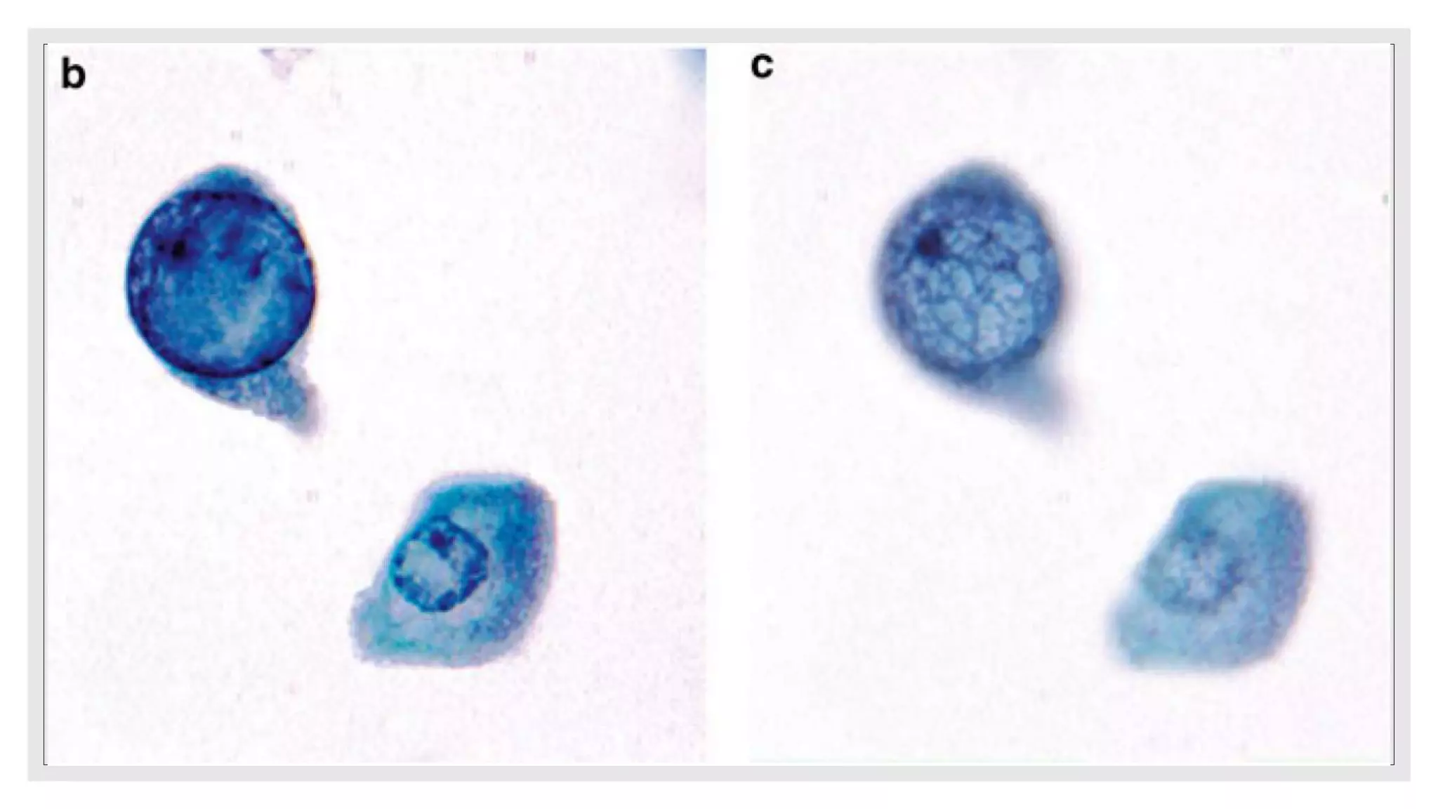 The Paris System for Reporting Urinary Cytology | PPTX