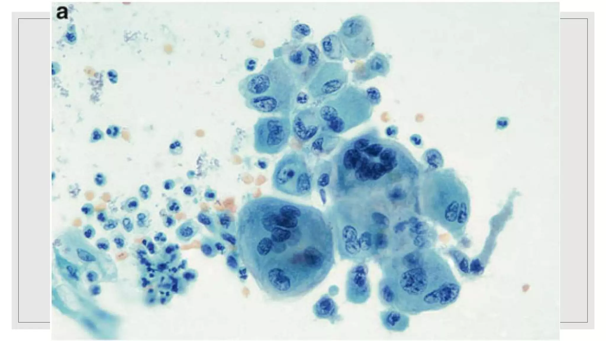 The Paris System for Reporting Urinary Cytology | PPTX