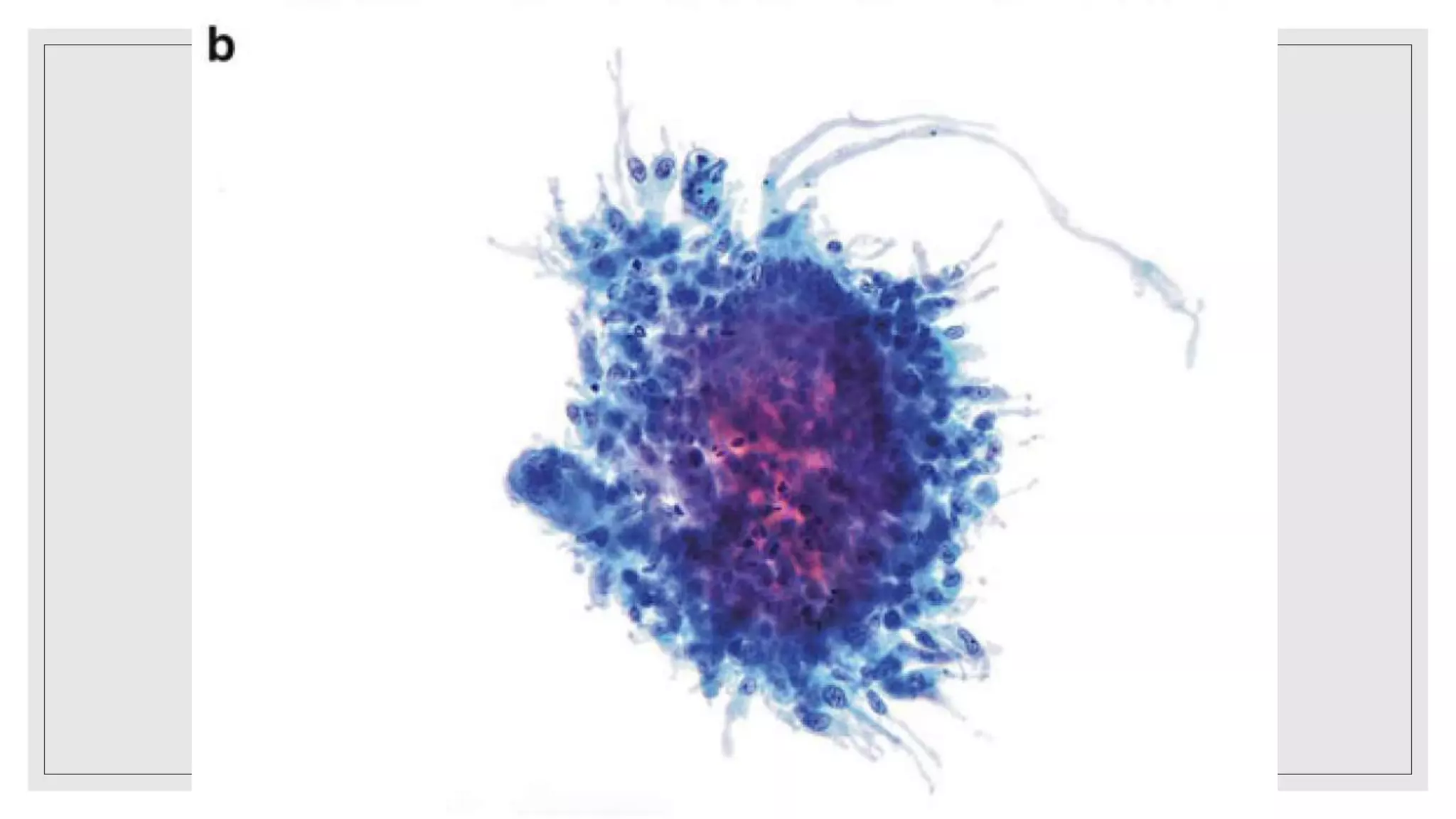 The Paris System for Reporting Urinary Cytology | PPTX