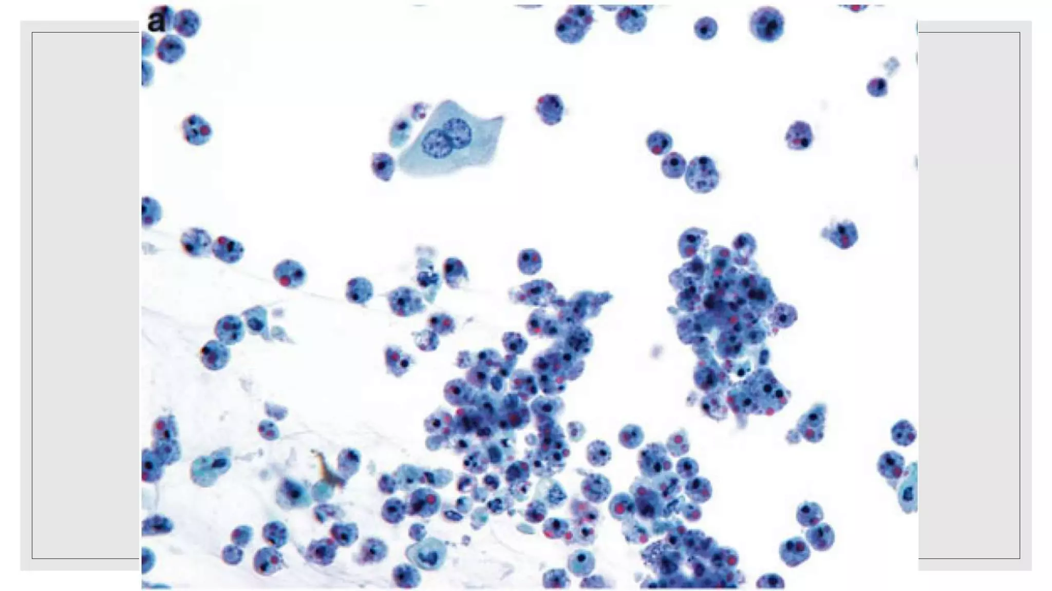 The Paris System for Reporting Urinary Cytology | PPTX