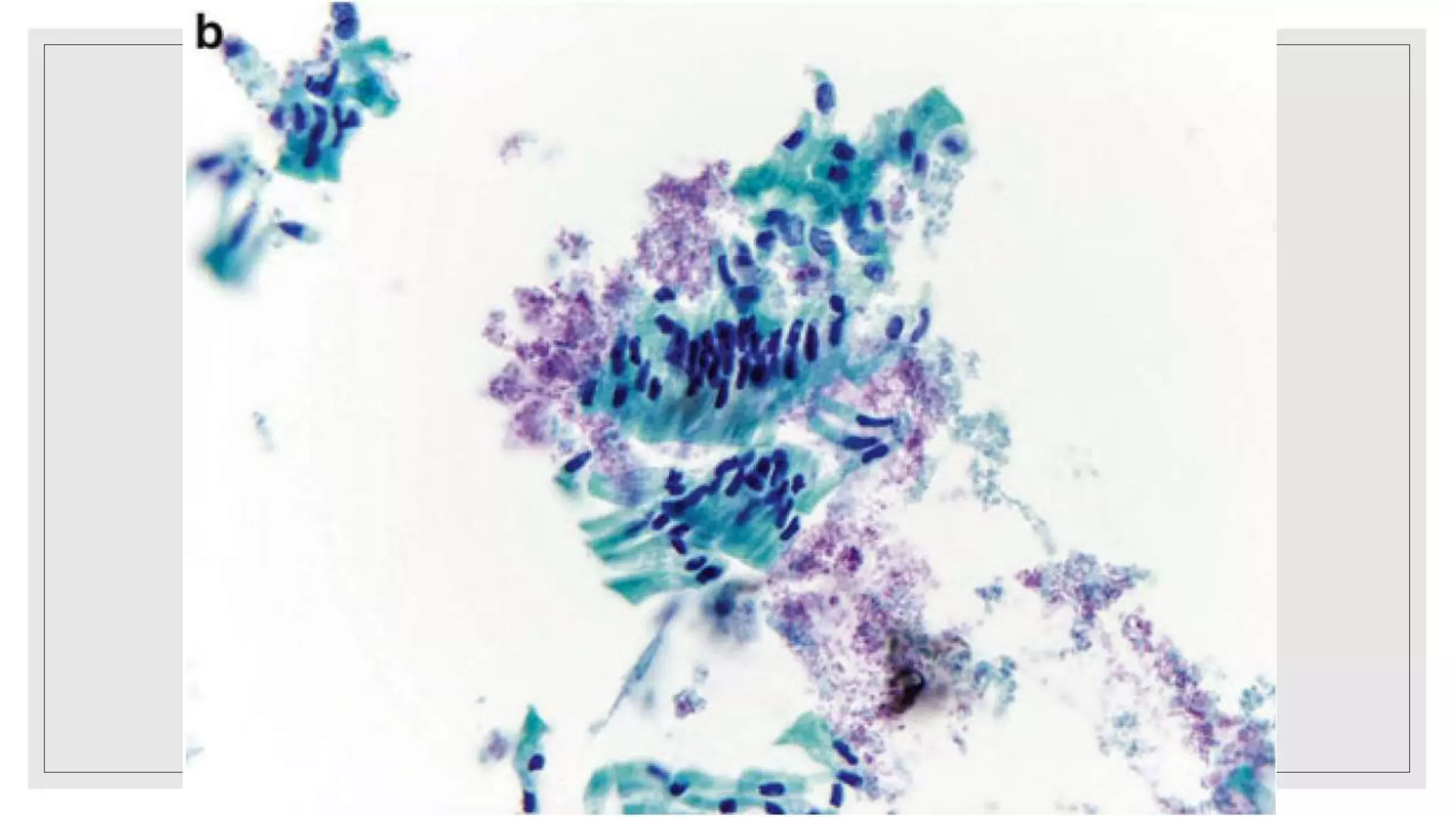 The Paris System for Reporting Urinary Cytology | PPTX