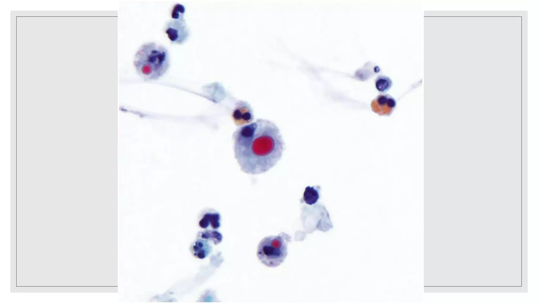 The Paris System for Reporting Urinary Cytology | PPTX