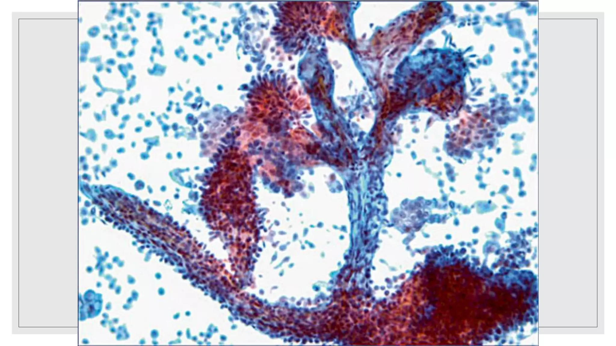 The Paris System for Reporting Urinary Cytology | PPTX