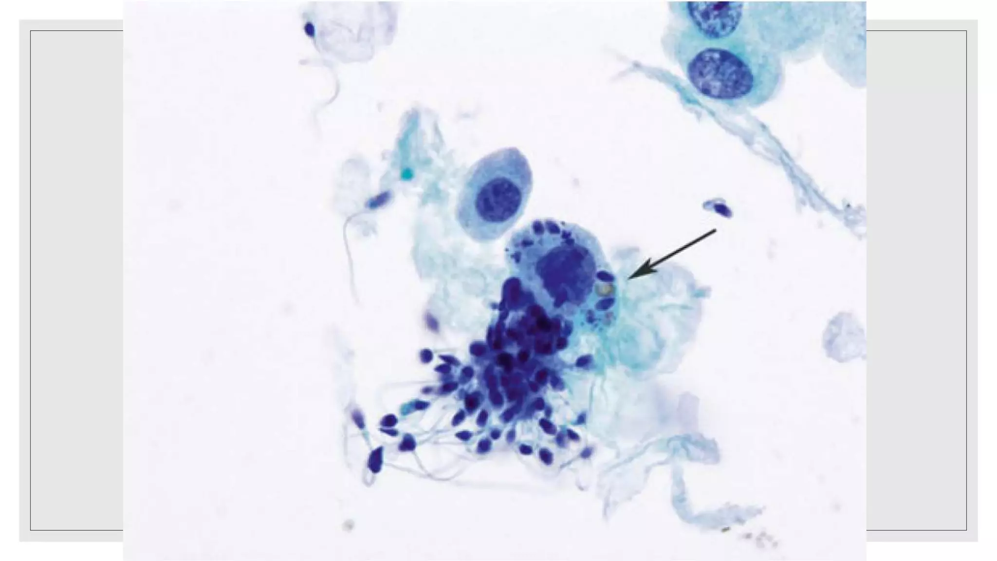 The Paris System for Reporting Urinary Cytology | PPTX