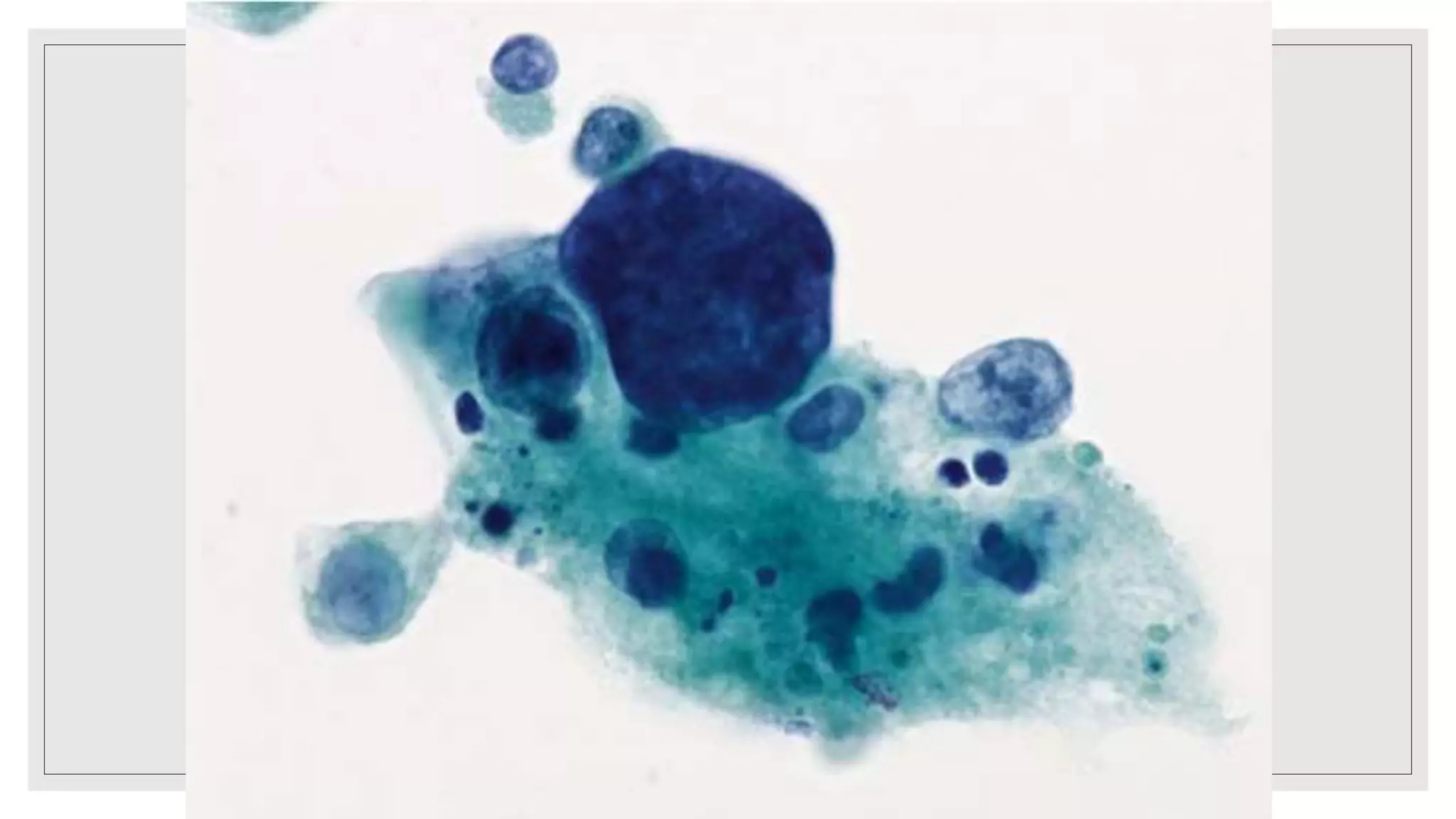 The Paris System for Reporting Urinary Cytology | PPTX