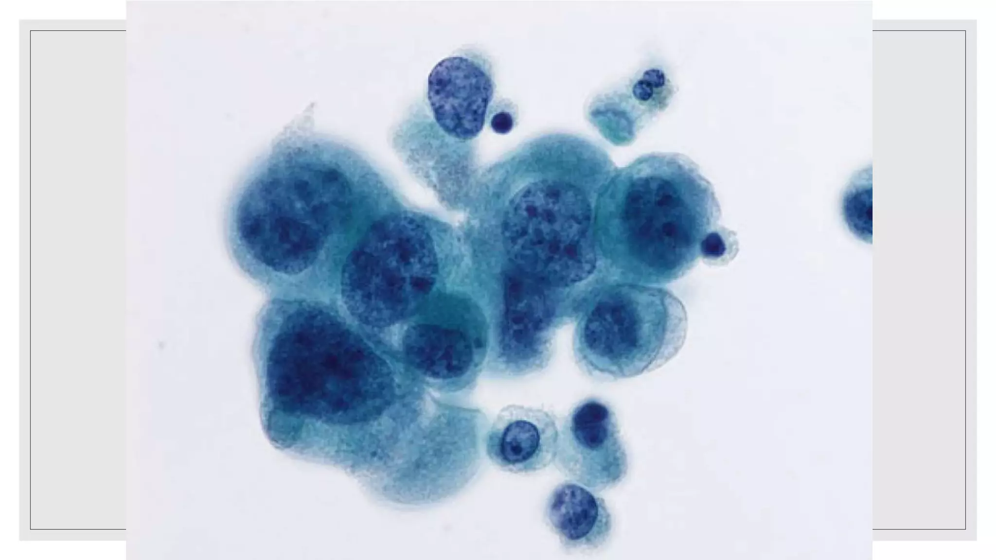 The Paris System for Reporting Urinary Cytology | PPTX