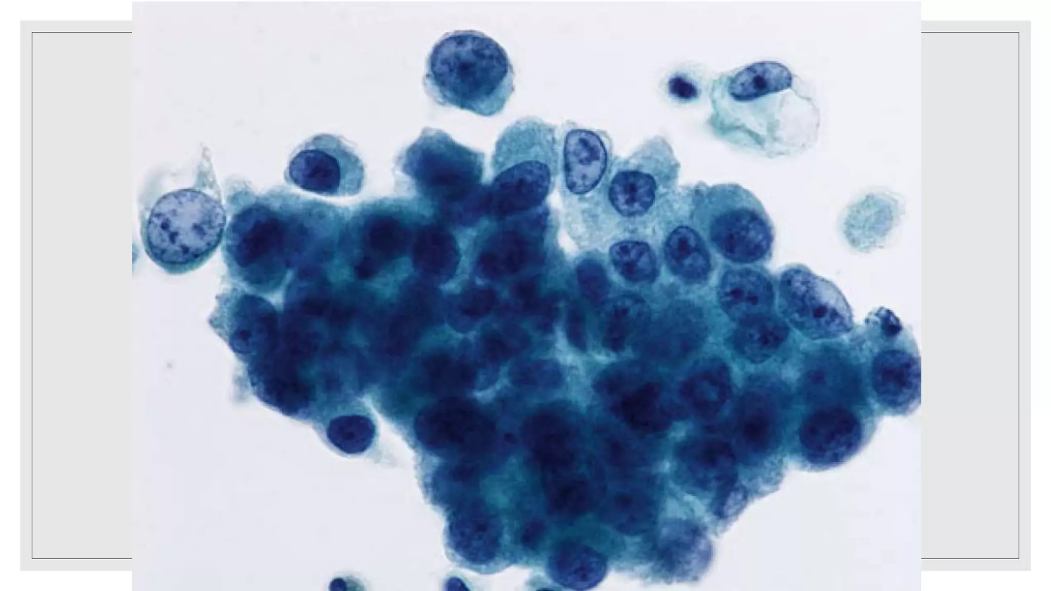 The Paris System for Reporting Urinary Cytology | PPTX