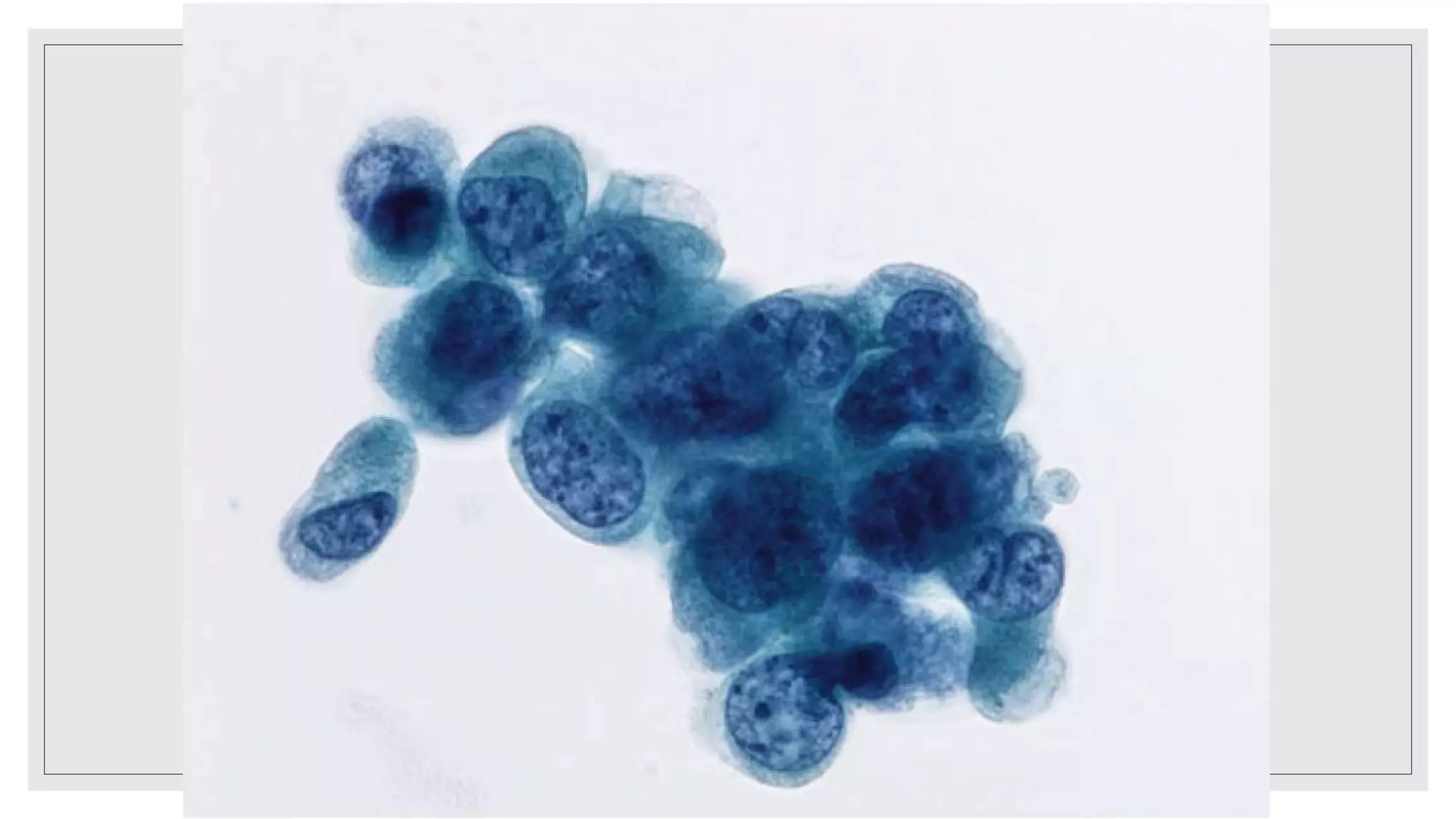 The Paris System for Reporting Urinary Cytology | PPTX