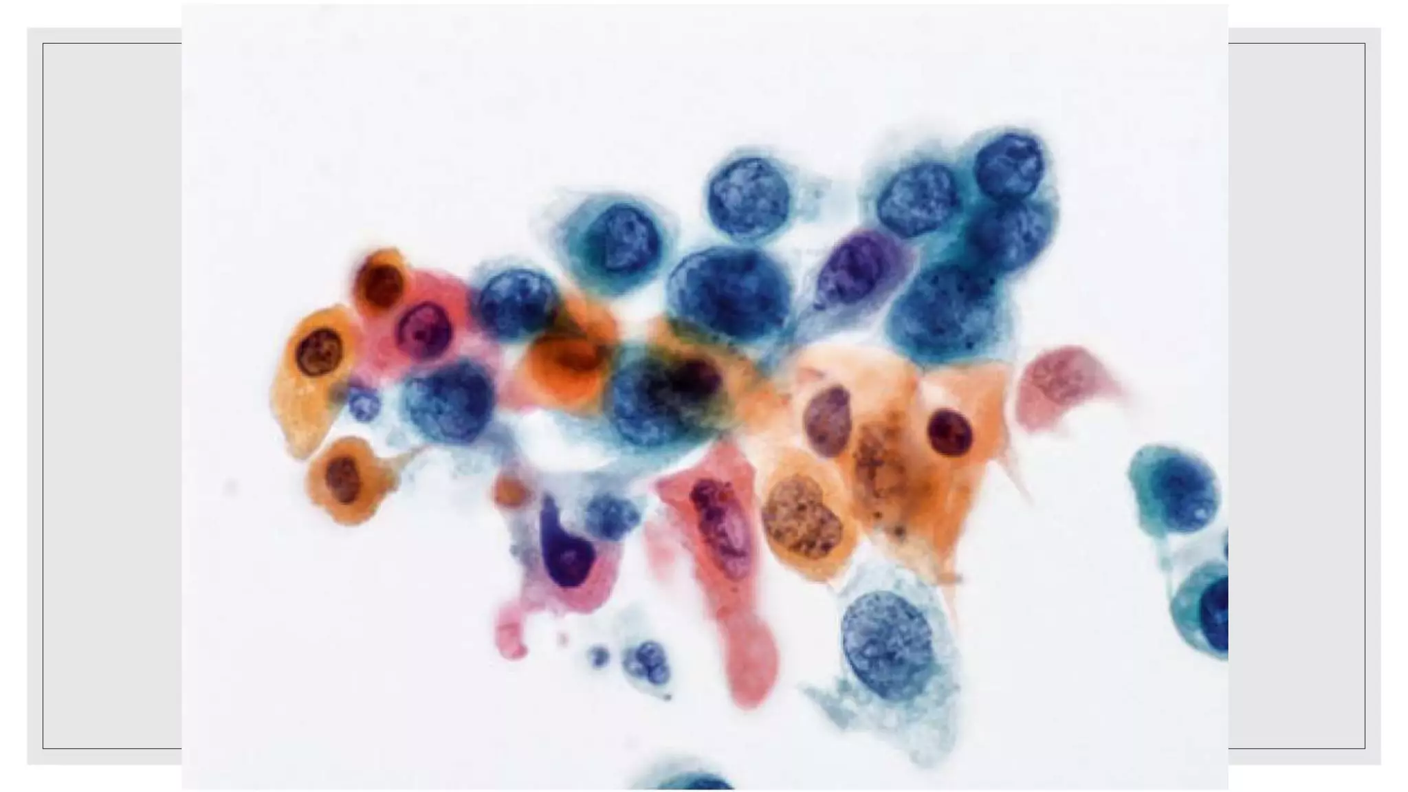 The Paris System for Reporting Urinary Cytology | PPTX