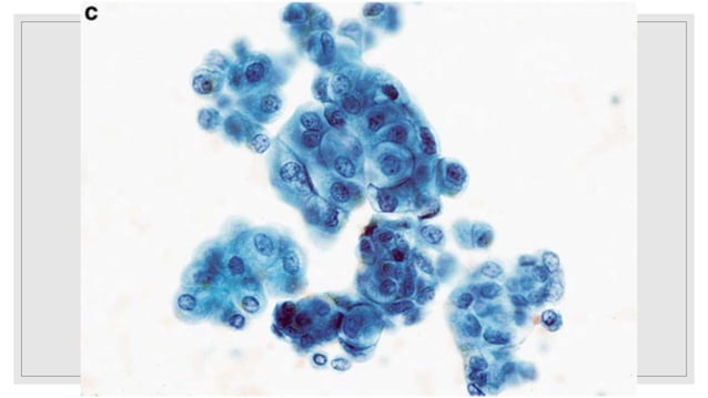 The Paris System for Reporting Urinary Cytology | PPTX | Cancer ...