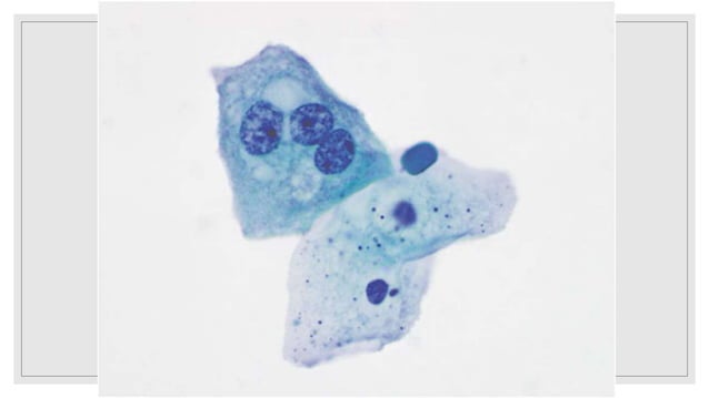 The Paris System for Reporting Urinary Cytology | PPTX | Cancer ...