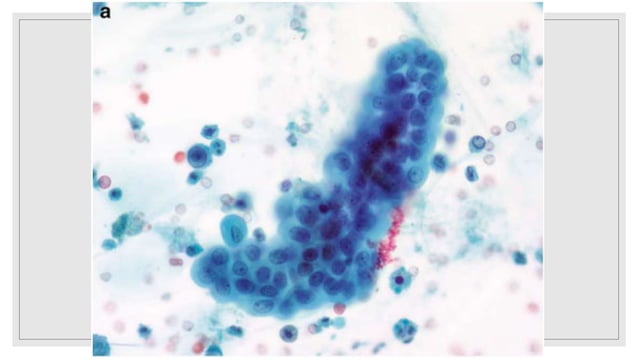 The Paris System for Reporting Urinary Cytology | PPTX | Cancer ...