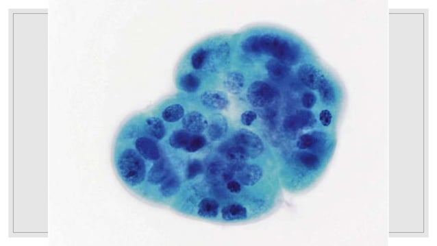 The Paris System for Reporting Urinary Cytology | PPTX | Cancer ...