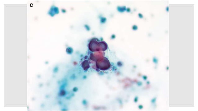 The Paris System for Reporting Urinary Cytology | PPTX | Cancer ...