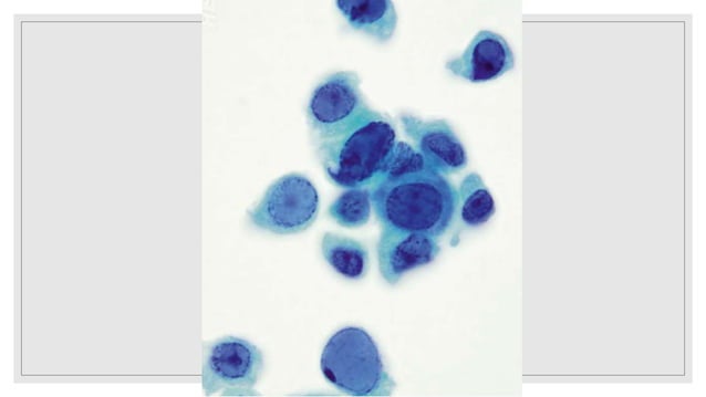 The Paris System for Reporting Urinary Cytology | PPTX | Cancer ...
