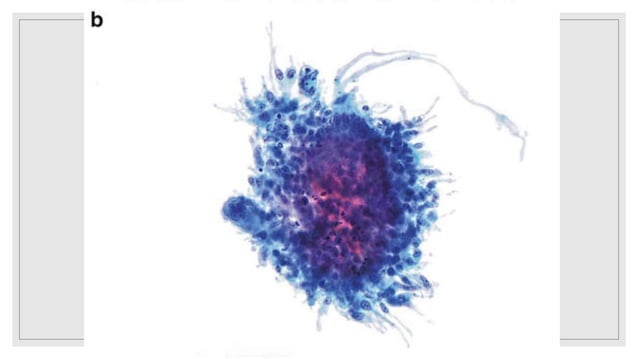 The Paris System for Reporting Urinary Cytology | PPTX | Cancer ...