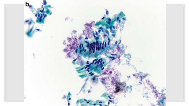 The Paris System for Reporting Urinary Cytology | PPTX | Cancer ...