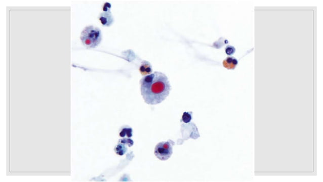 The Paris System for Reporting Urinary Cytology | PPT