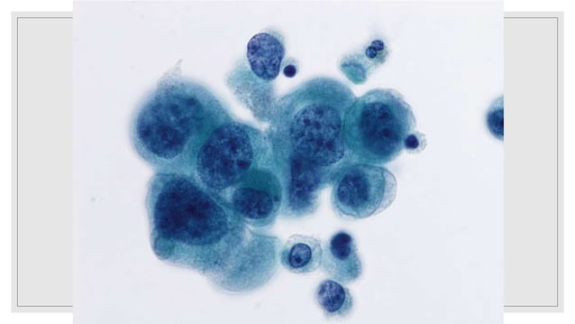 The Paris System for Reporting Urinary Cytology | PPTX | Cancer ...