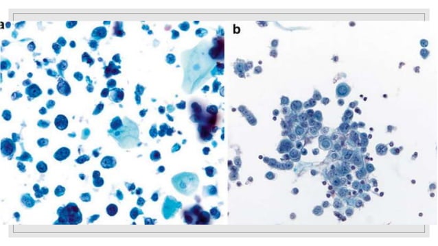 The Paris System for Reporting Urinary Cytology | PPTX | Cancer ...