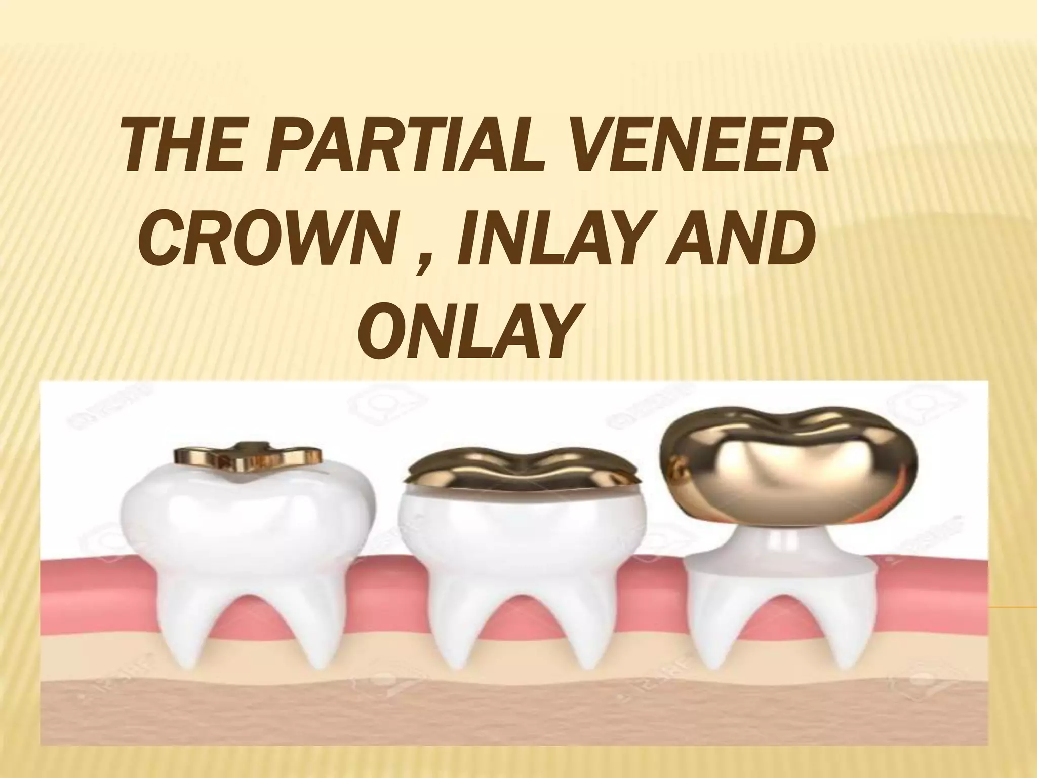 The partial veneer crown , inlay and onlay.pptx