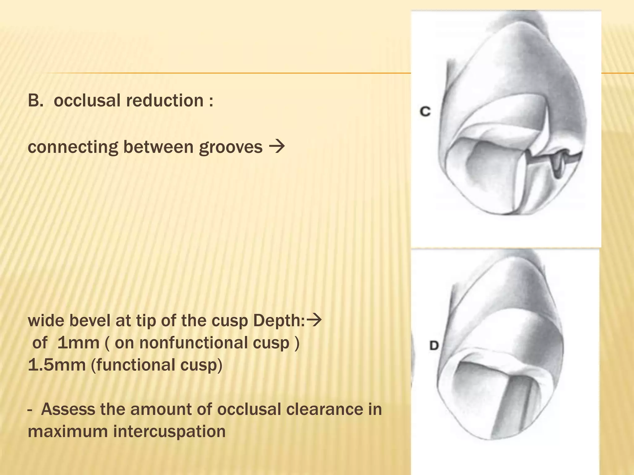 The partial veneer crown , inlay and onlay.pptx