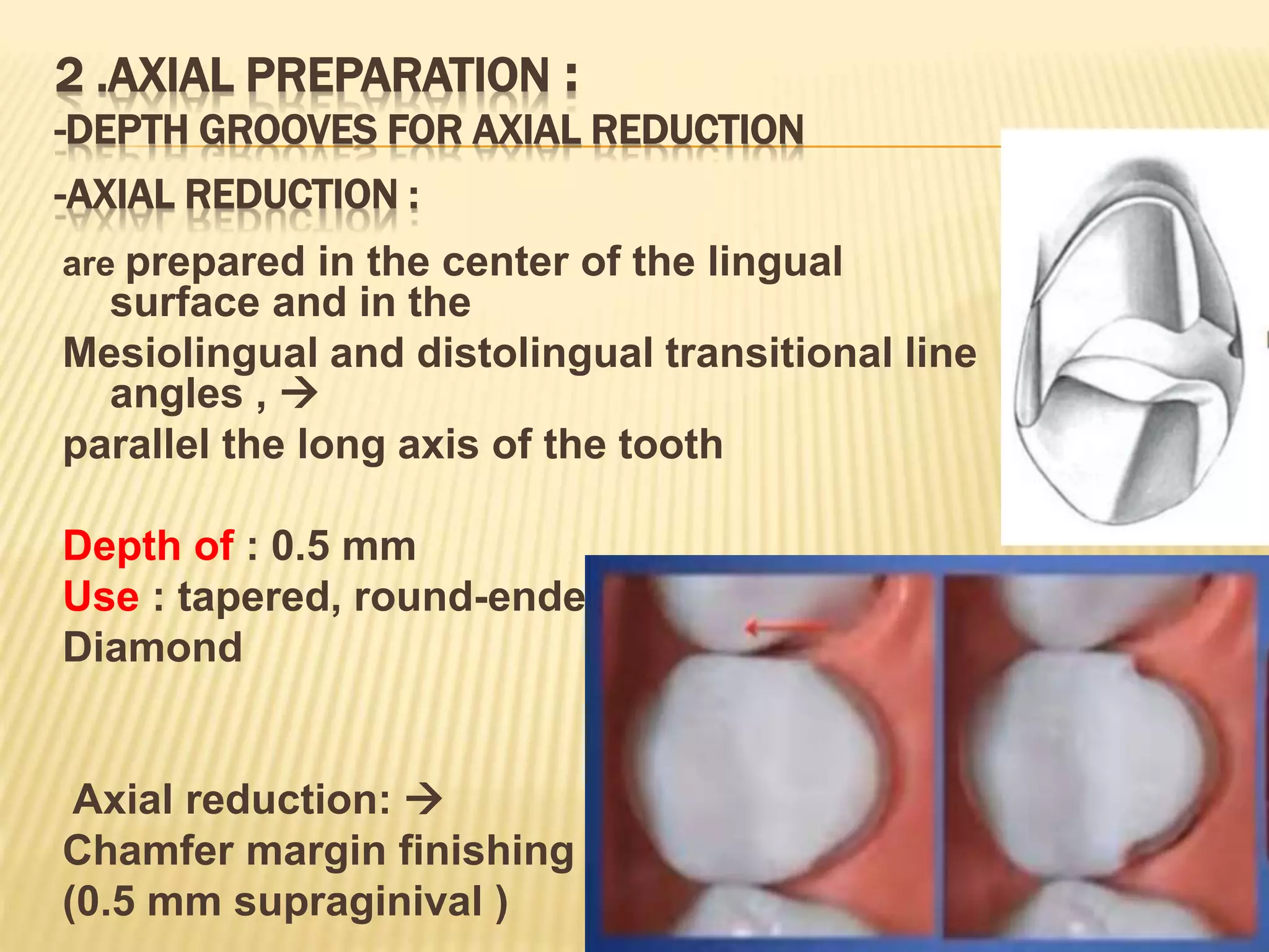 The partial veneer crown , inlay and onlay.pptx