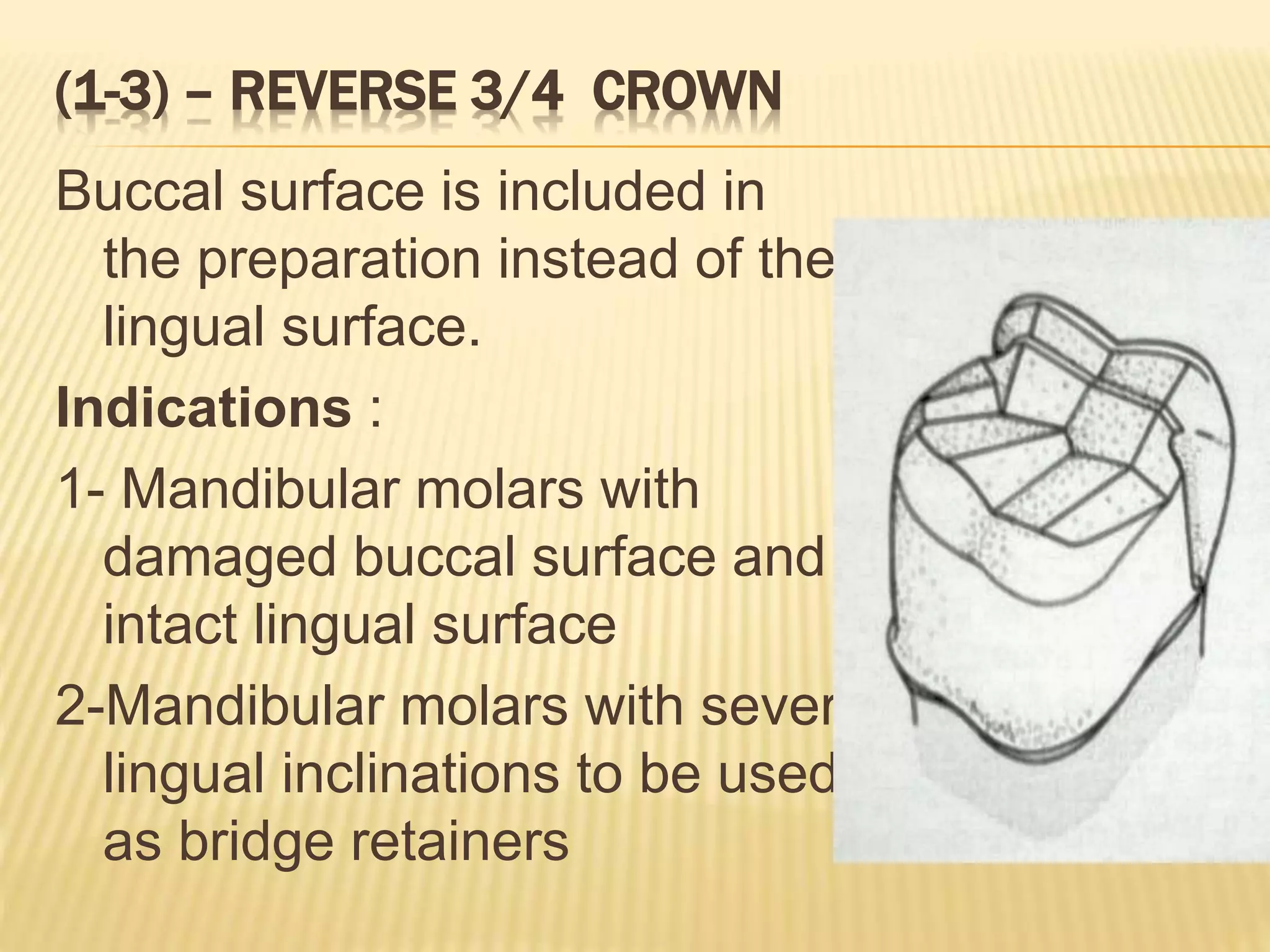 The partial veneer crown , inlay and onlay.pptx