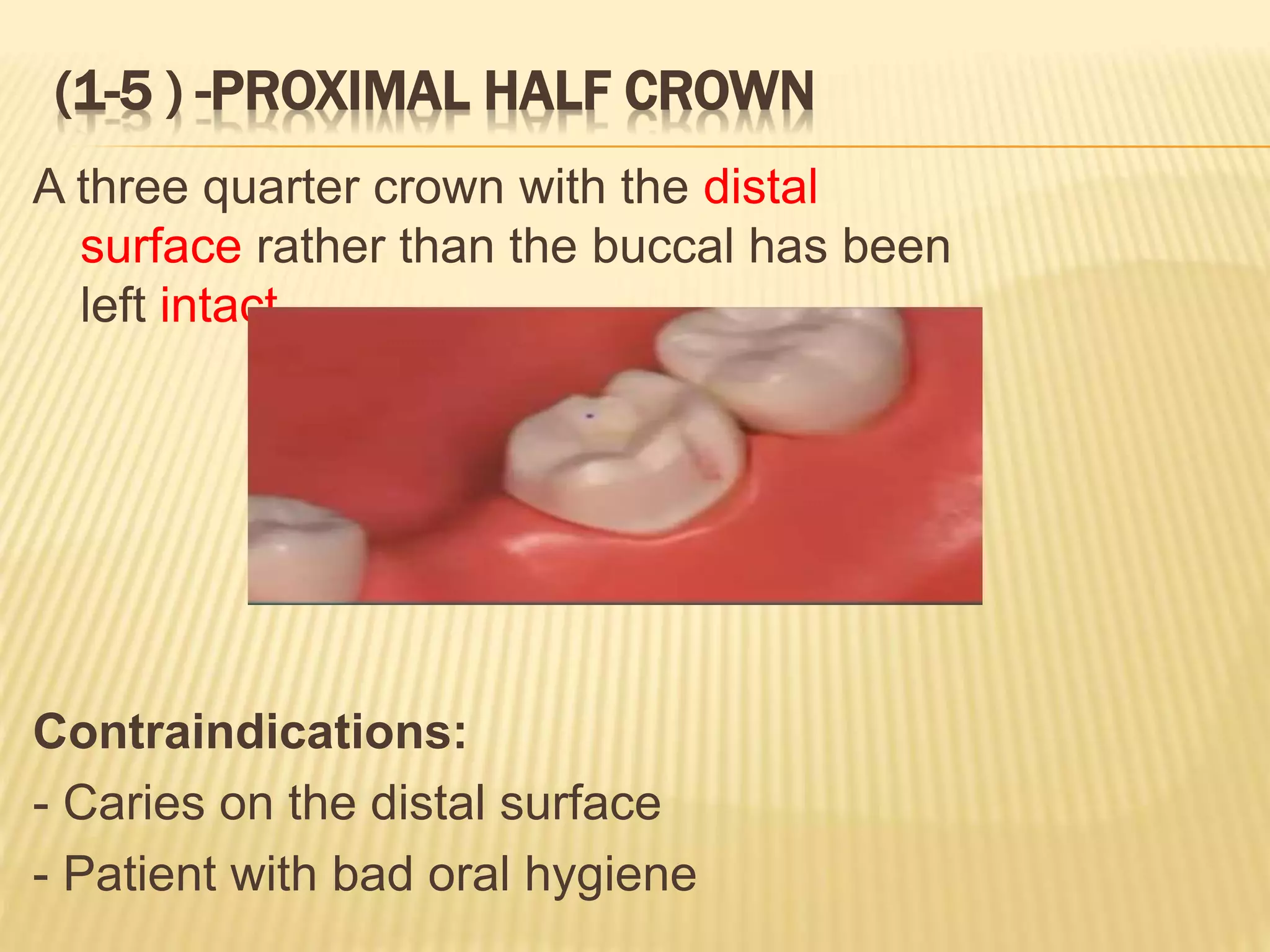 The partial veneer crown , inlay and onlay.pptx