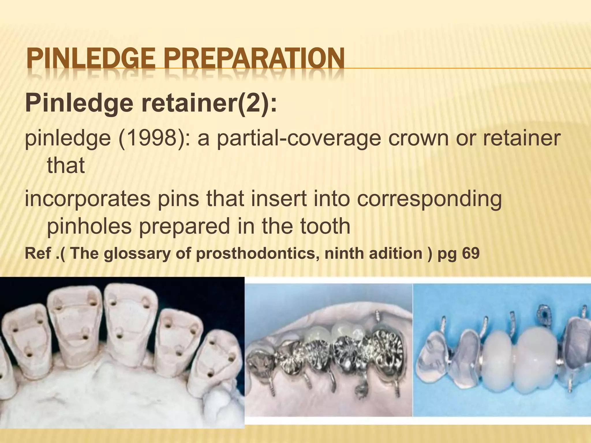 The partial veneer crown , inlay and onlay.pptx