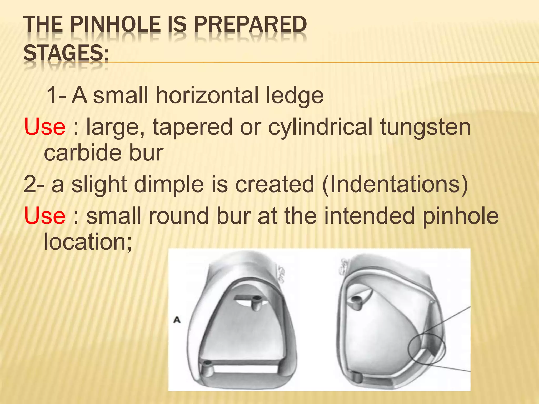 The partial veneer crown , inlay and onlay.pptx