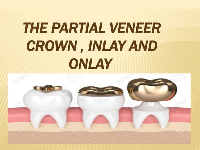 The partial veneer crown , inlay and onlay.pptx | Dental Health ...