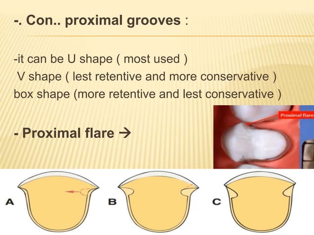 The partial veneer crown , inlay and onlay.pptx | Dental Health ...