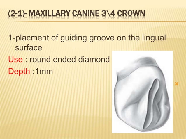 The partial veneer crown , inlay and onlay.pptx | Dental Health ...