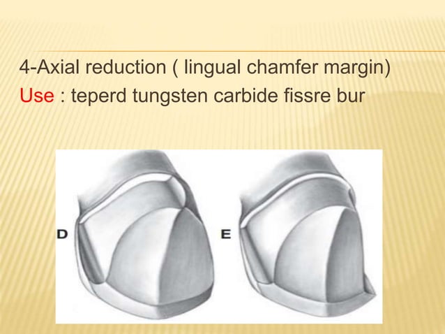 The partial veneer crown , inlay and onlay.pptx | Dental Health ...
